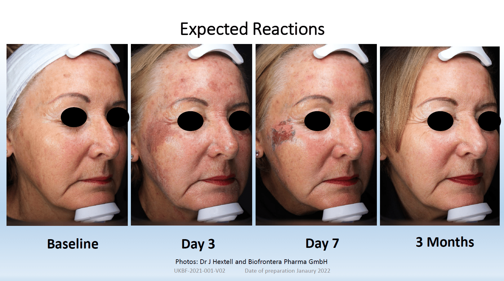 Daylight Photodynamic Therapy with AMELUZ® Didn’t Work for Me – My ...